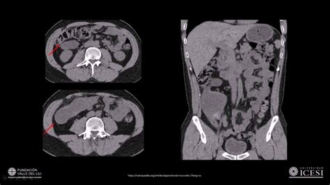 Radiología En 5 Minutos Mucocele Apendicular Youtube