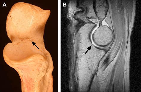 Trochlear Notch Knee