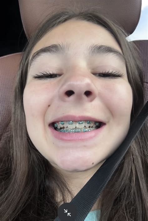 Teaaaaa Braces And Invisalign Pictures Braces Before And After Smile