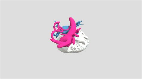 Mapcas Pulmonary Atresia Vsd S0364 3d Model By Nchs Cardiac