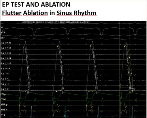 atrial flutter afl ablation af ablation
