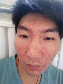 水痘掉痂后红印子图片 搜狗图片搜索