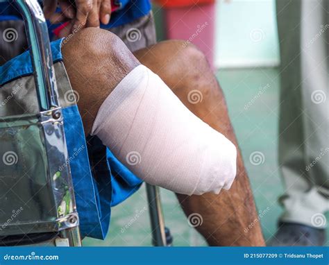 Amputee Woman Gets Below Knee Amputation Amputee Leg Prosthesis