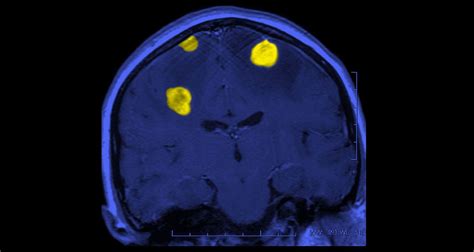 Treating Brain Metastasis As A Distinct Disease
