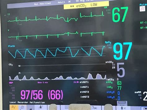 A Systematic Approach To Capnography Waveforms Ems Airway