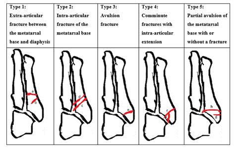 5th Metatarsal Fracture Classification Corgros 5th Metatarsal Fracture Classification Corgros
