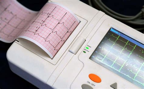 Wie Sieht Ein Langzeit Ekg Aus