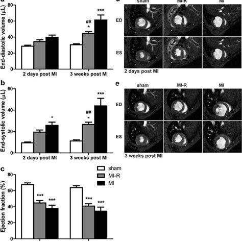 Cardiac Mr Imaging Of Lv Volumes And Function Assessment Of Lv Volumes Download Scientific