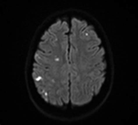 Mri Scan Dwi Sequence Illustrating The Distal Embolization Related