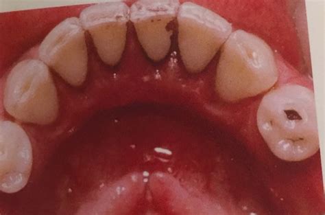 Dental Caries Flashcards Quizlet