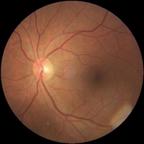 Retinal Disease Classification Classification Dataset By