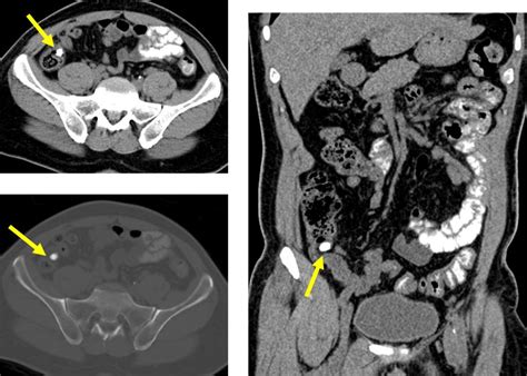 Appendicolith Radiology Cases