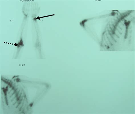 Limited Bone Scan Using Tc99m This Demonstrates Diffusely Increased Download Scientific