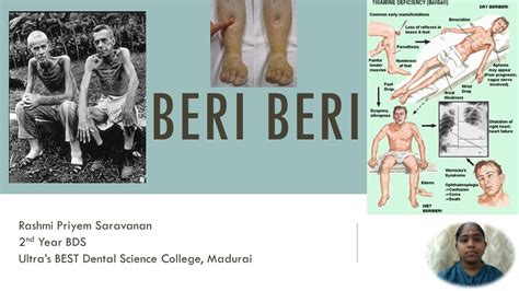 Beriberi Edema