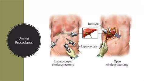Cholecystectomy Pptx