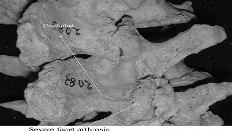Prevalence Of Lumbar Facet Arthrosis And Its Relationship To Spine