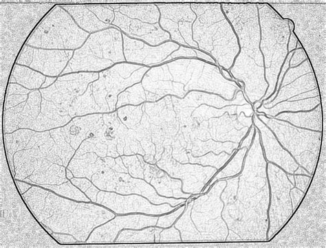 Python Vessel Segmentation In Retina Image Stack Overflow