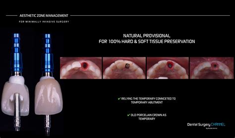 Decision Making Process In The Aesthetic Zone