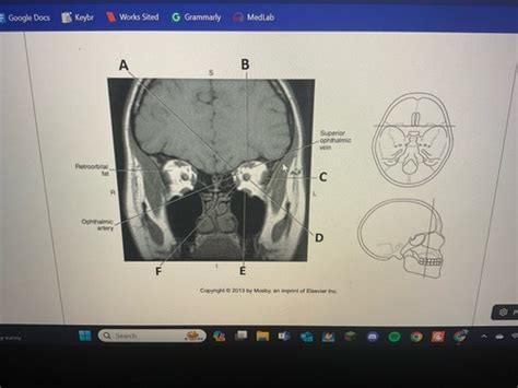 Week 1 Assignment 4 Tmj Paranasal Sinuses Eye Muscles Flashcards Quizlet