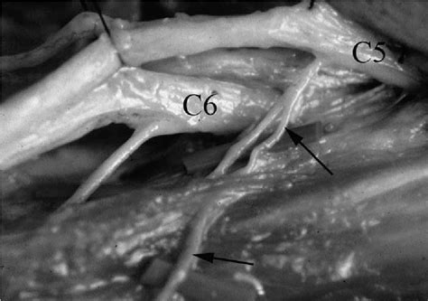 Figure 2 From Long Thoracic Nerve Anatomy And Functional Assessment