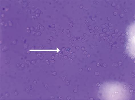 Difference Between Gout And Pseudogout Difference Between 47 Off