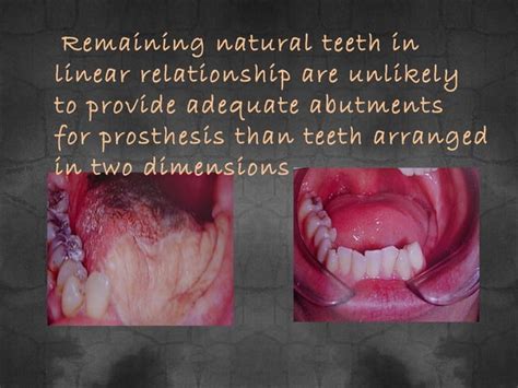 Prosthodontic Management Of Mandibular Defects Ppt