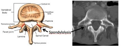 Pars Fracture Lumbar Spine