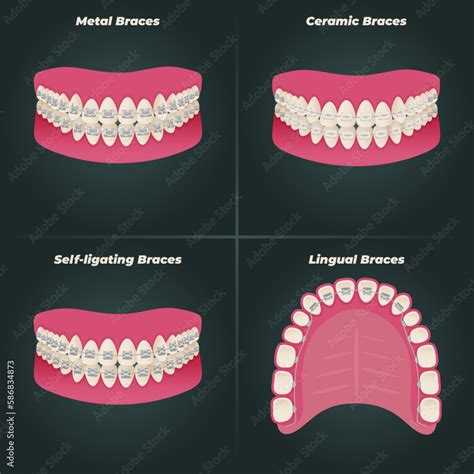 The Concept Of Teeth Alignment With Braces Orthodontic Dentistry The Alignment Of The Teeth