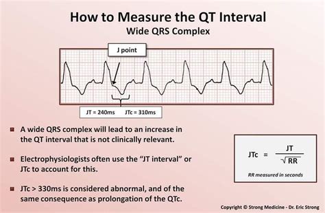 🔴 How To Measure Qt Interval And Calculate The Qtc Copyright Strong Medicine Dr Eric Strong Qt