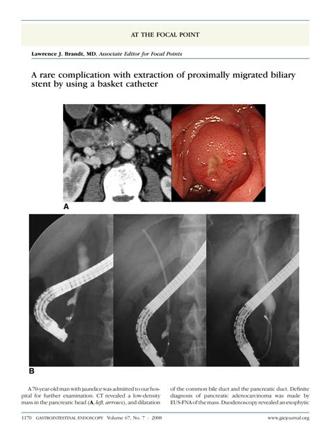 Pdf A Rare Complication With Extraction Of Proximally Migrated