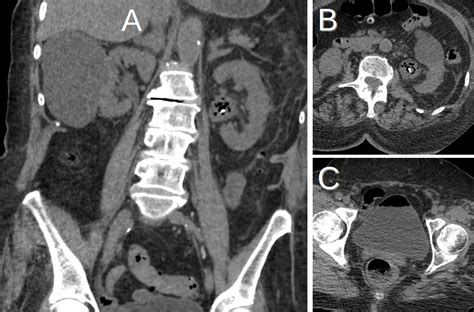 Emphysematous Pyelonephritis