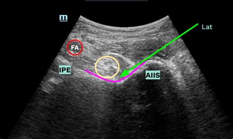 Ultrasound Peng Block Model Sinai Em Ultrasound Peng Block Model Sinai Em