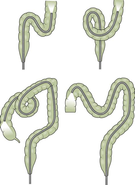 Colonoscopy Polypectomy And Related Techniques Clinical Tree Colonoscopy Polypectomy And Related Techniques Clinical Tree