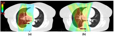 Radiation Pneumonitis Old Problem New Tricks
