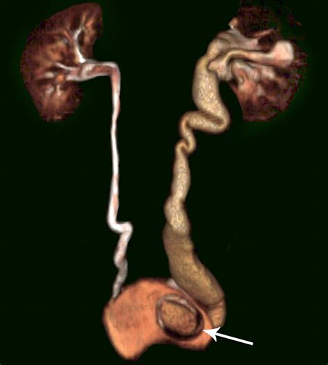 Inflammatory And Nonneoplastic Bladder Masses Radiologic Pathologic