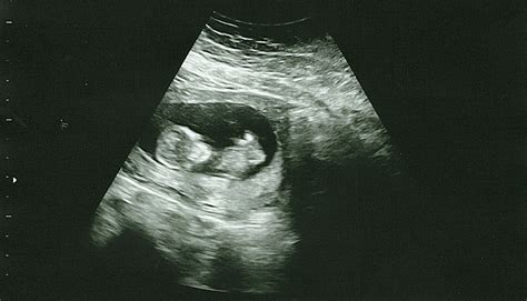 12 Week Ultrasound Gender