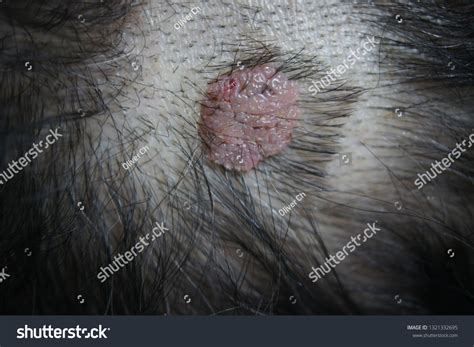 Scalp Warts Filiform Wart Dermoscopy Stock Image C0596869
