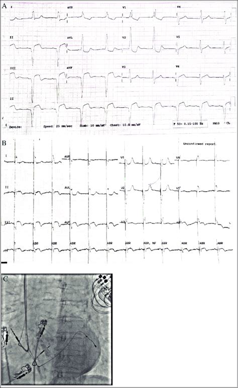 A Preprocedure ECG Of Patient 2 B Postprocedure ECG Of Patient 2 Download Scientific