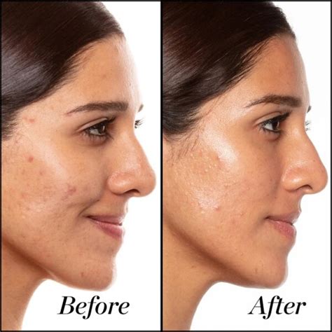 Retinol Before And After Transform Your Skin With These Results Must