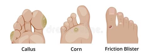 Callus Corn And Friction Blister Affecting Human Foot Skin Stock Illustration Illustration Of