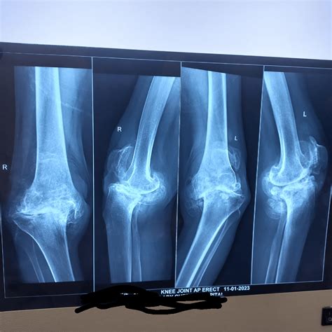 Osteoarthritis Knee Xray