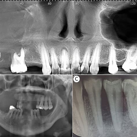 Radiographic Features Of Low Grade Myofibroblastic Sarcoma Computed