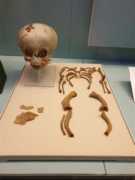 Osteogenesis Imperfecta Pathophysiology And Treatment My Endo Consult