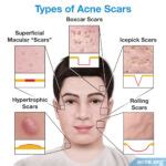 What Causes A Pimple To Scar Acne Org