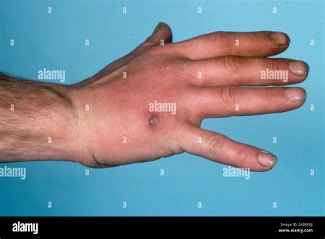 Inflamed Lymph Vessels In The Hand View Of A Patients Swollen Hand