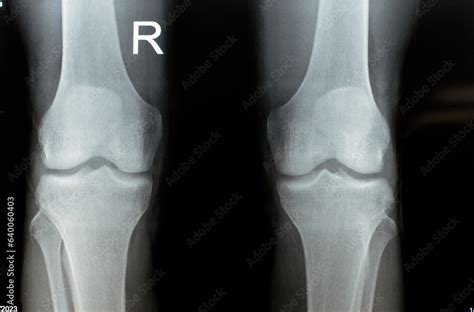 Plain X Ray Of Both Right And Left Knee Joints With Lower Part Of Femur
