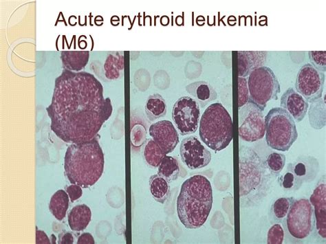 Acute Myeloid Leukemia Pptx