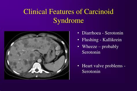 Ppt Neuroendocrine Tumours Current Treatments Powerpoint Presentation Id4275492