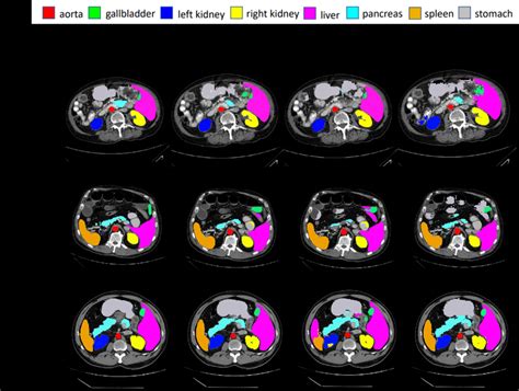 Visualization Of Segmentation Results On The Synapse Dataset Our