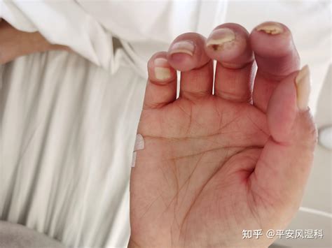 硬皮病患者手指出现雷诺现象怎么办？ 知乎